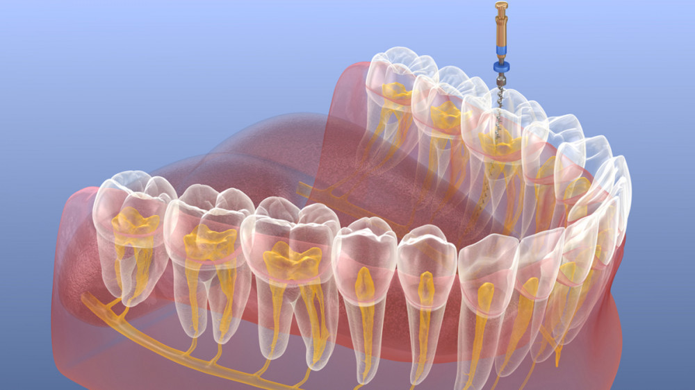 Endodoncija - Ariadent